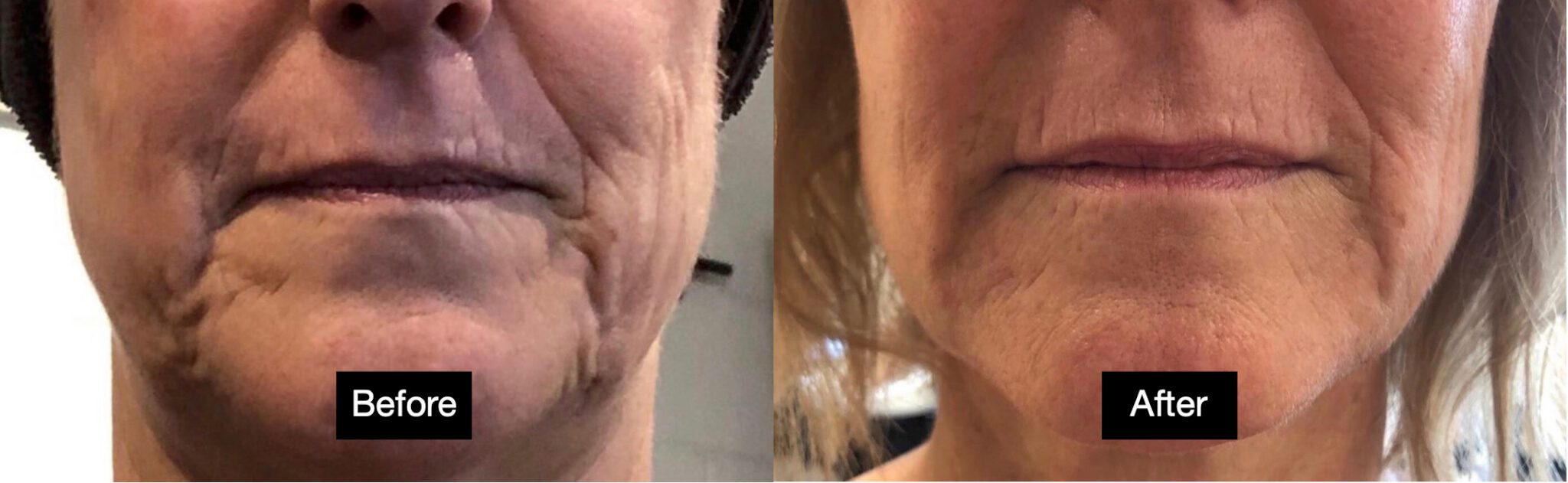 Fillers: FAQs - Grand Salon & MedSpa Denver