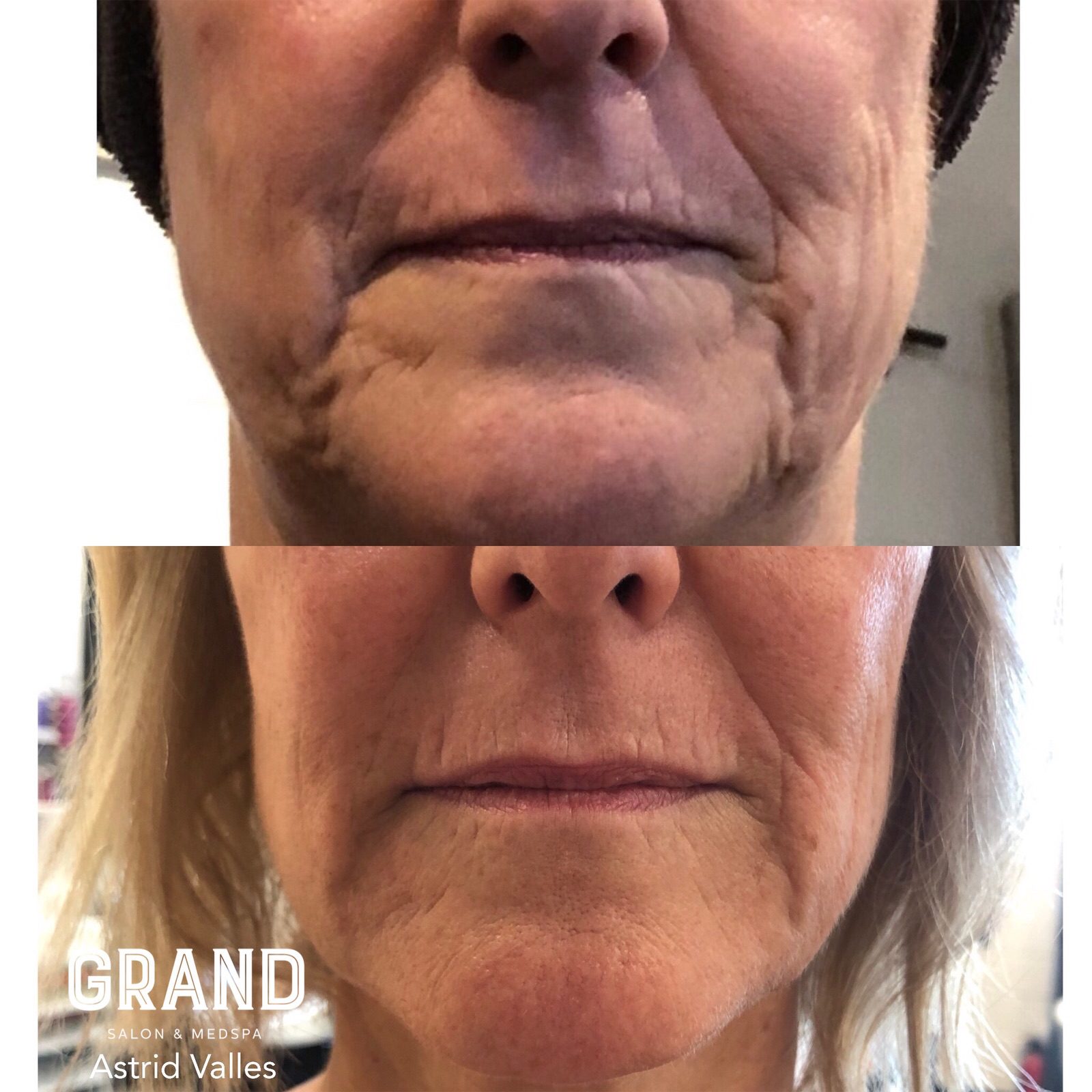 Fall for a Filler - Grand Salon & MedSpa Denver